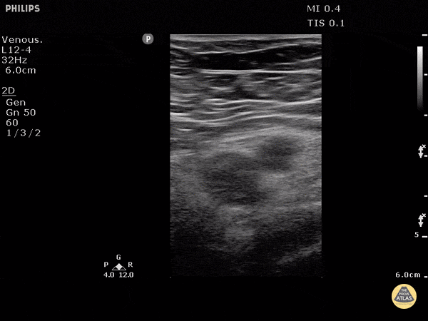 DVT ultrasound - WikEM