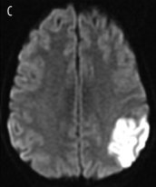 Brain MRI - WikEM