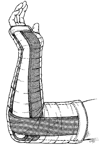 Double sugar tong splint - WikEM