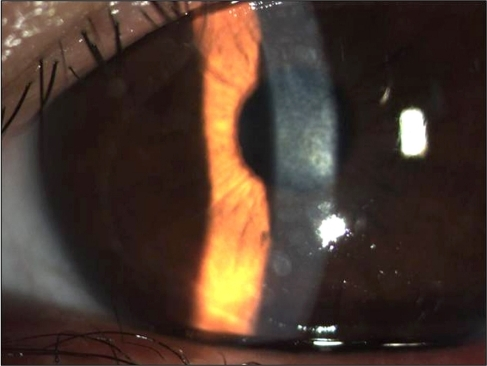 Epidemic keratoconjunctivitis - WikEM