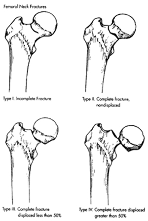 Intertrochanteric femur fracture - WikEM