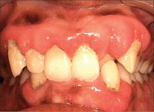 Gingival hyperplasia - WikEM