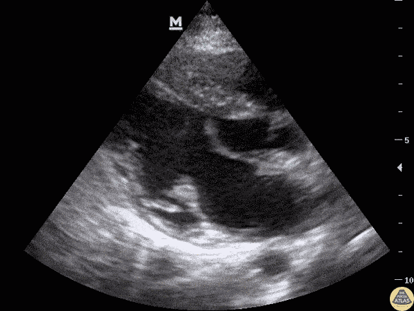 Hypertrophic cardiomyopathy - WikEM