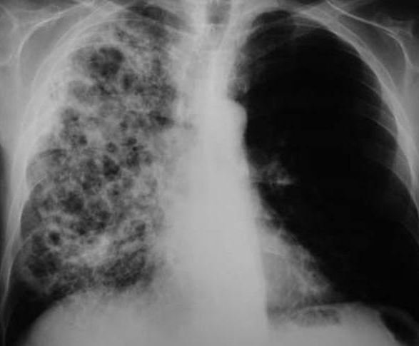 Histoplasmosis - WikEM