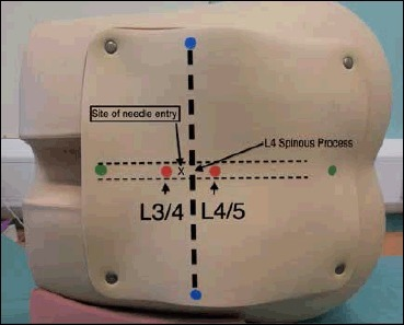 Lumbar puncture - WikEM