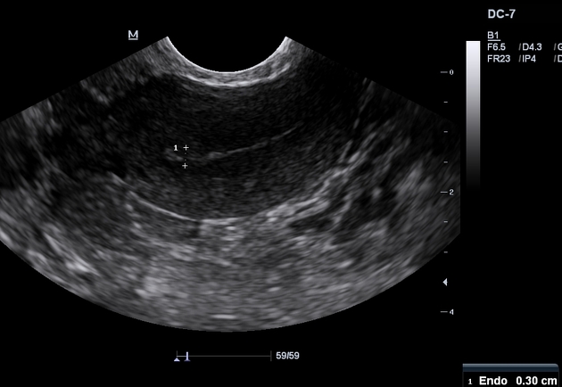 File:Menstrual endometrium.JPG - WikEM