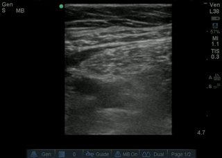 DVT ultrasound - WikEM