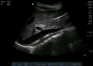 Biliary ultrasound - WikEM