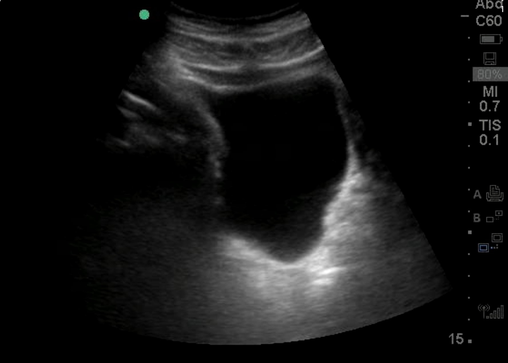 File:Normal sagittal bladder.jpg - WikEM