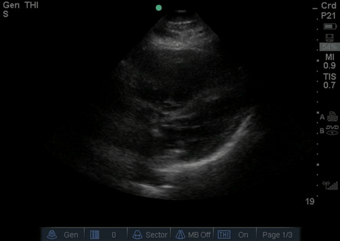 File:Normal subxiphoid.gif - WikEM