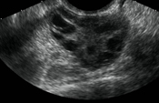 Pelvic ultrasound (transvaginal) - WikEM