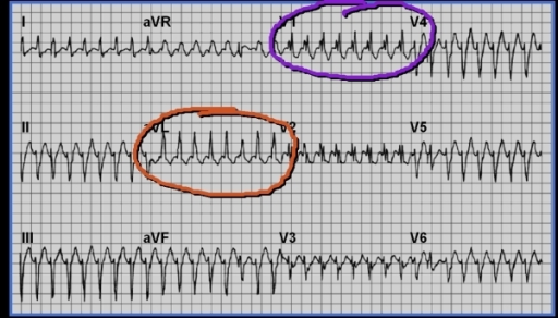 Idiopathic fascicular left ventricular tachycardia - WikEM
