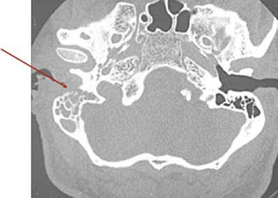 Malignant otitis externa - WikEM