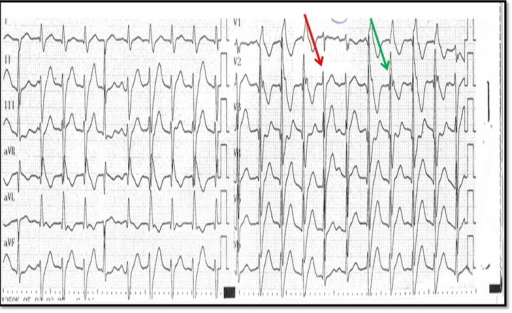 Idiopathic fascicular left ventricular tachycardia - WikEM