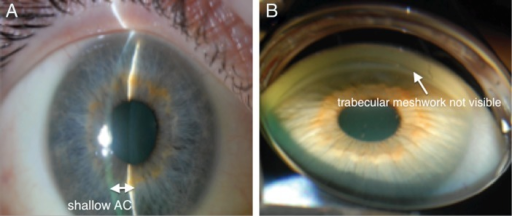 Acute angle-closure glaucoma - WikEM