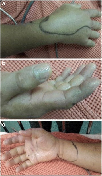 Stonefish envenomation - WikEM