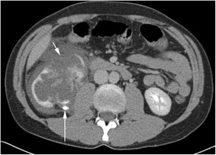 Renal trauma - WikEM