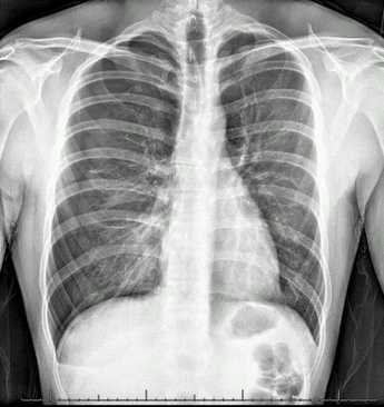 Traumatic pneumothorax - WikEM