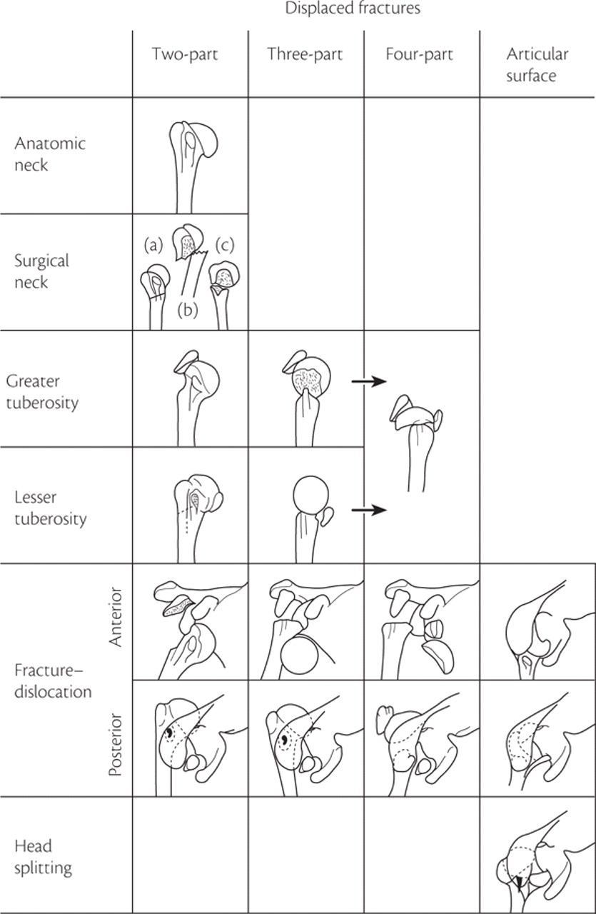 File:Prox humerus fracture.jpeg - WikEM