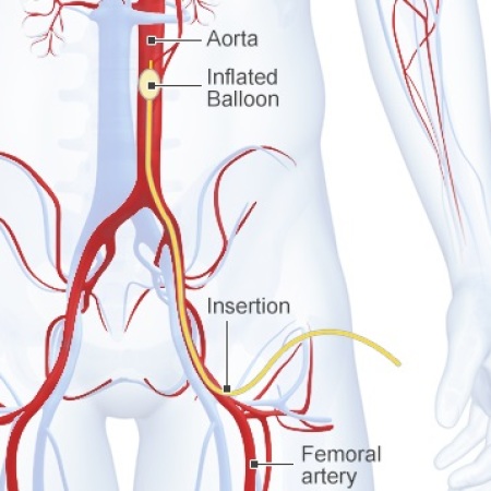 Resuscitative endovascular balloon occlusion of the aorta - WikEM