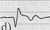 ST-segment elevation myocardial infarction - WikEM