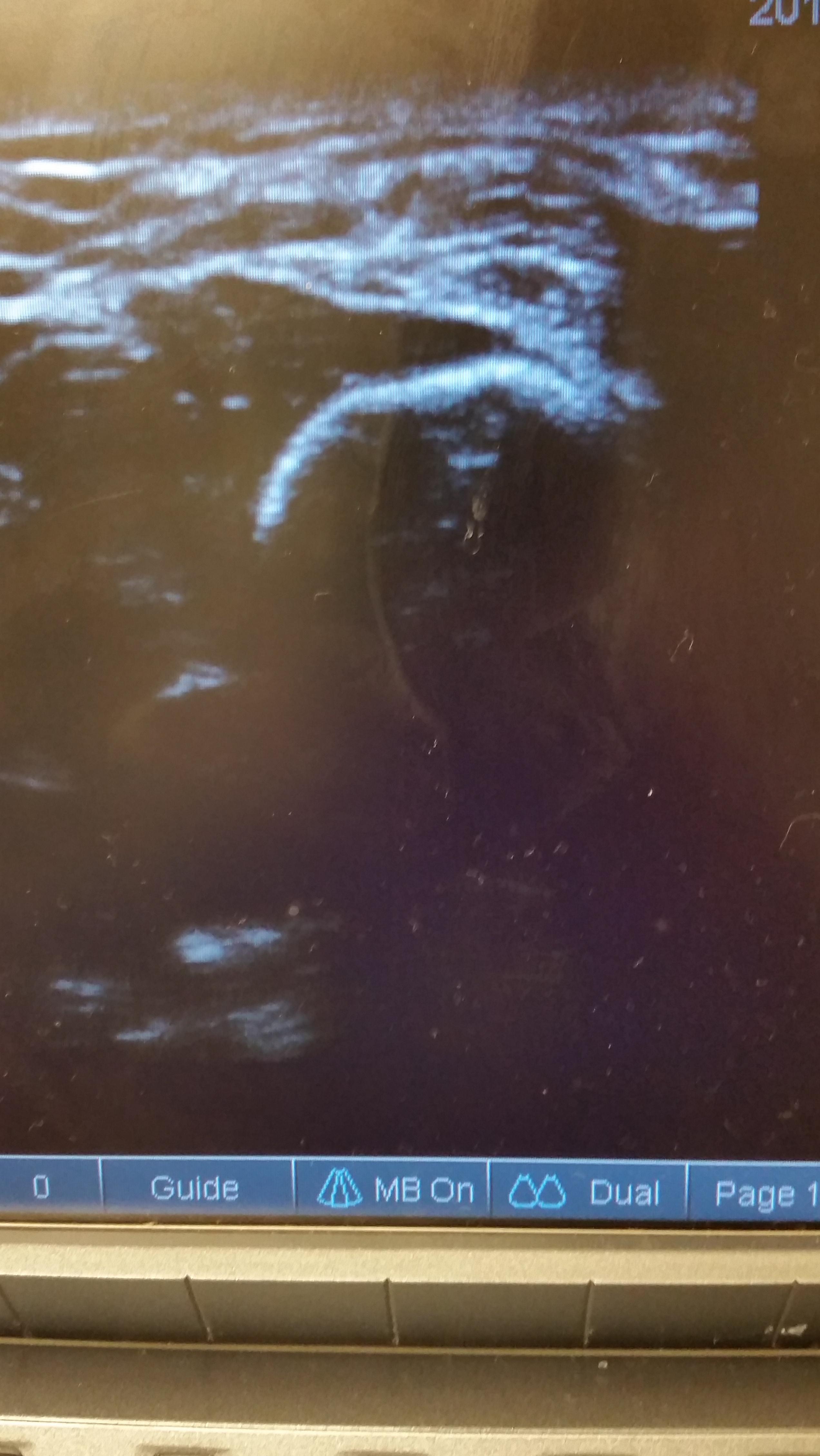 File:Short Access Bone.jpg - WikEM