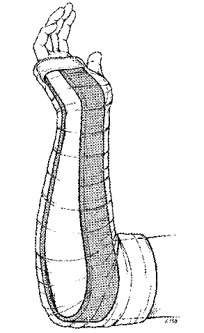 Sugar tong splint - WikEM