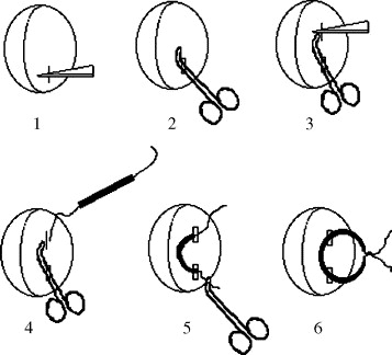 Bartholin gland abscess - WikEM