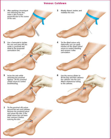 Venous cutdown - WikEM