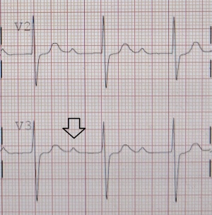 First degree AV block - WikEM