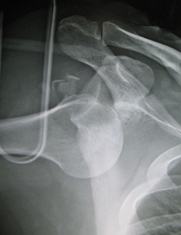 Inferior shoulder dislocation - WikEM