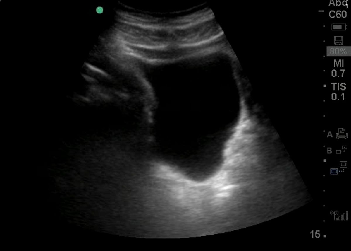 File:Normal sagittal bladder.jpg - WikEM