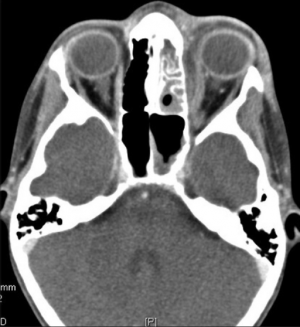 Subperiosteal Abscess
