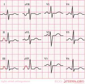 Right atrial enlargement - WikEM