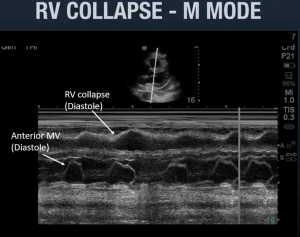 Pericardial effusion and tamponade - WikEM