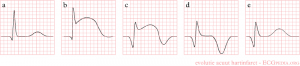 ST-segment elevation myocardial infarction - WikEM