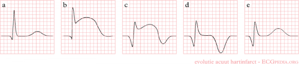 ST-segment elevation myocardial infarction - WikEM