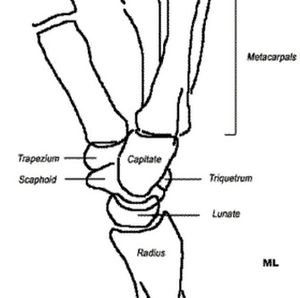 Carpal fractures - WikEM